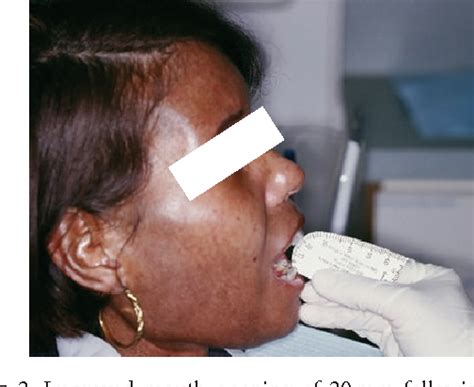 Figure From Limited Mouth Opening Secondary To Diffuse Systemic Sclerosis Semantic Scholar