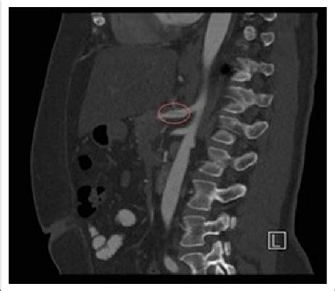 Initial Ct Angiogram Demonstrating The Celiac Artery Dissection