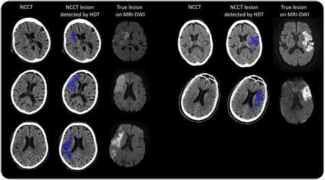 Frontiers Novel Artificial Intelligence Based Hypodensity Detection