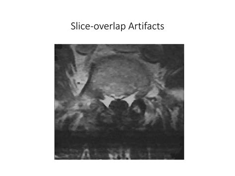 Mri Artifacts Introduction Classification Types Ppt