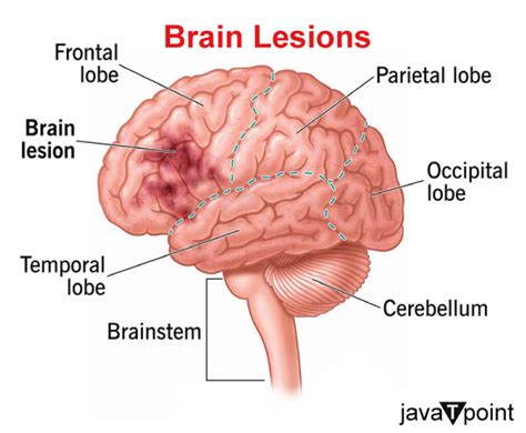 Brain Lesions Tpoint Tech