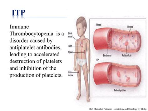 Immune Thrombocytopenia Itp Pptx