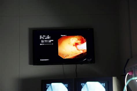 Ercp Procedure Done To Remove Stones Islamabad Gastroenterology