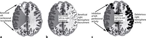 Different Accounts Of Plasticity In Language Systems In Chronic