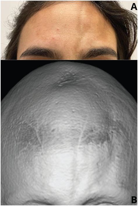 Multiple Cerebral Cavernomas In Linear Scleroderma An Unusual Association Arquivos De Neuro Multiple Cerebral Cavernomas In Linear Scleroderma An Unusual Association Arquivos De Neuro