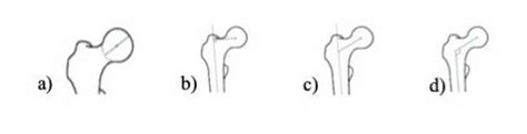 Illustrations Of Pelvic Parameters Measured By Eos™ Imaging Software