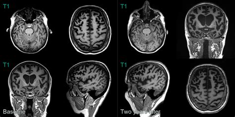 Frontotemporal Dementia Ftd Neuroradiology