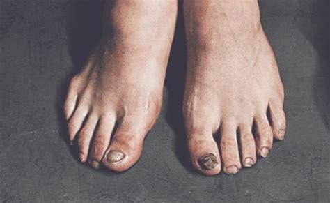 새카만 발톱 멍 이유 있다 작은발 손흥민의 비밀 중앙일보
