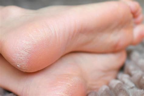 Premium Photo Closeup Dry Skin Of Heels With Cracks On Feet