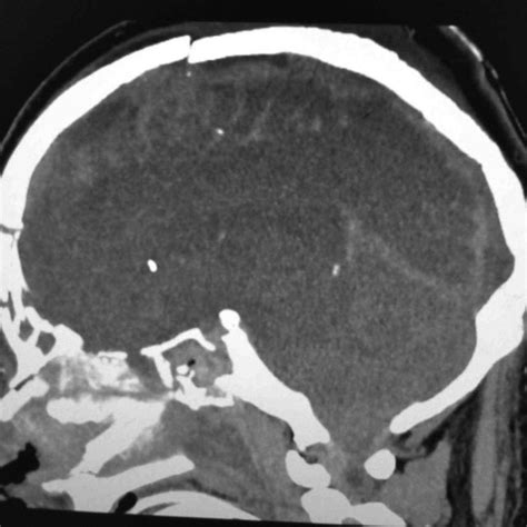 CT Non Contrast Brain Demonstrating Diffuse Cerebral Oedema Thin Right Download Scientific
