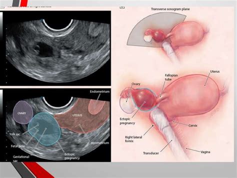 Ectopic Pregnancy Radiology Ppt