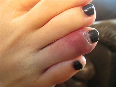 How To Mend A Broken Toe At Home Health Broken Toe Remedies