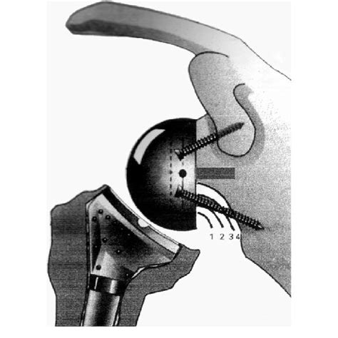Notching Classification According To Sirveaux Et Al [2] And Nerot Et