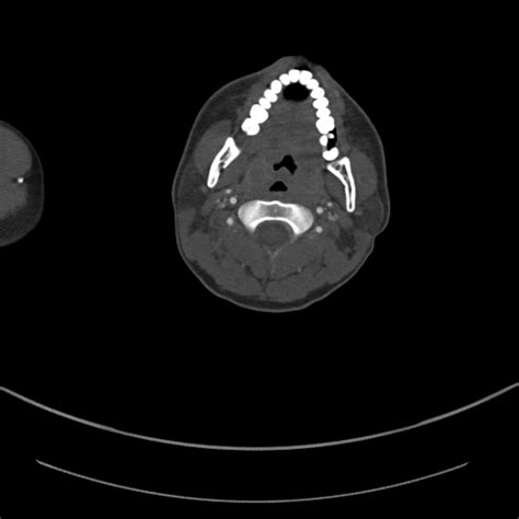 Brachiocephalic Trunk Pseudoaneurysm Radiopaedia 70978 81191 Axial