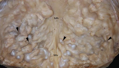 Severe Form Type D Of Hyperostosis Frontalis Interna The Midline Of Download Scientific