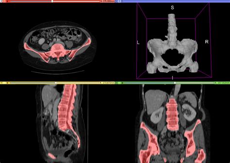 example of ct skeleton detection and segmentation by image morphology