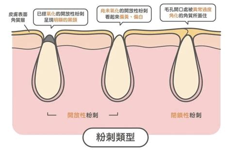 【暗瘡101】和您了解暗瘡種類、形成原因及處理方法 Beauty Place