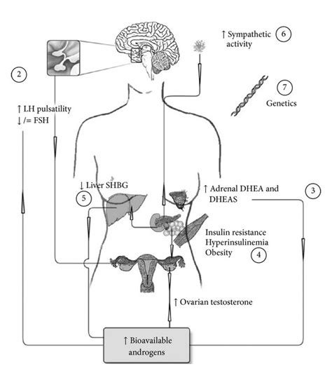 Summary Of The Pcos Pathophysiology 1 Ovarian Androgens Are The Main
