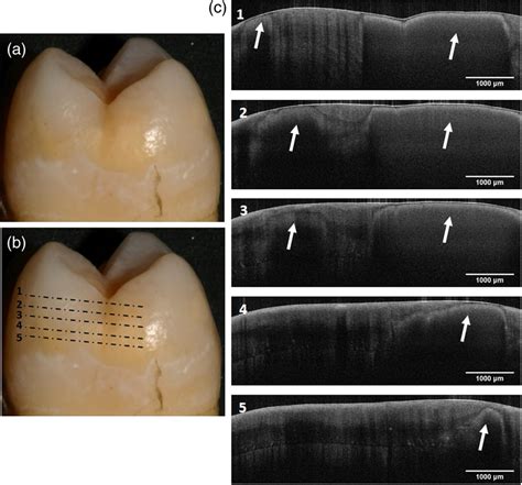 A MIH Affected Tooth Showing A Demarcated T2 Defect B Clinical