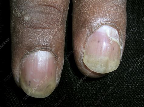 Psoriasis Stock Image C060 2380 Science Photo Library