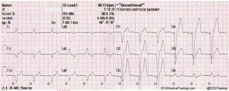 Atrial Pacing