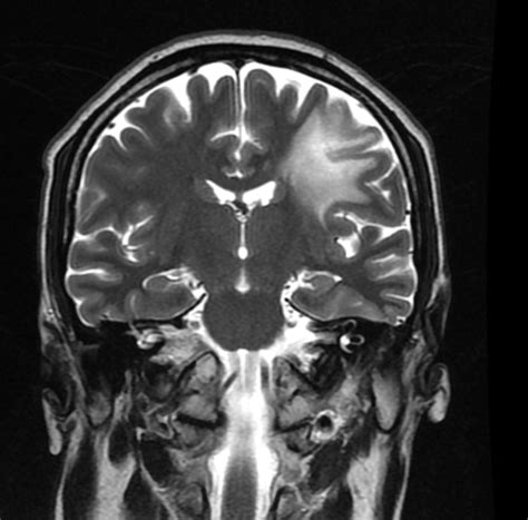 Tumefactive Demyelinating Lesion Pacs