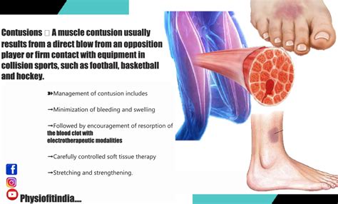 Contusion