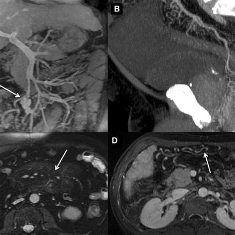 Portal Venous Phase Mr Images Show The Increased Caudate Right Lobe