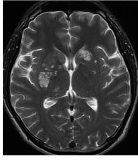 Figure 1 From Imaging Characterization Of Cryptococcal Meningoencephalitis Semantic Scholar