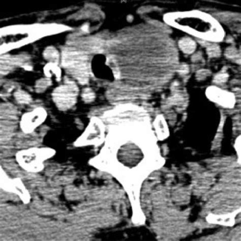 Hypodense Left Thyroid Lesion 4 0 × 3 9 Cm Causing Displacement Of The Download Scientific