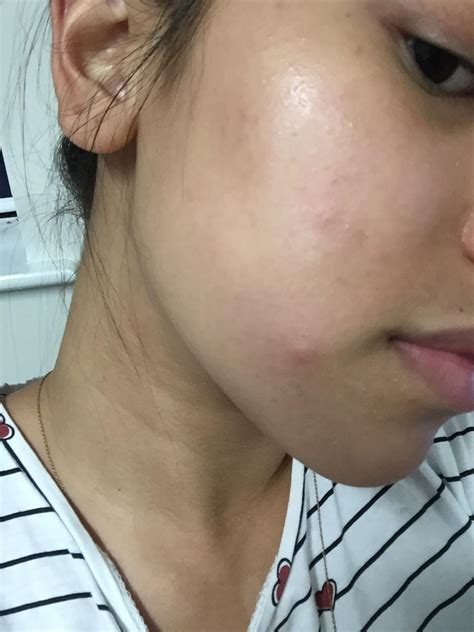 Skin Concerns Help Me Identify What These Red Bumps On My Face Are