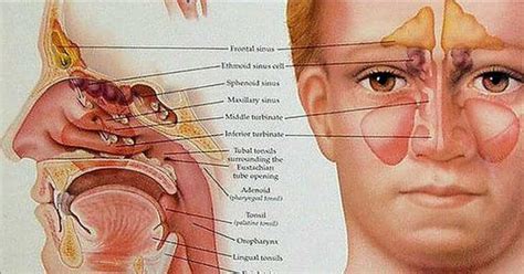 What Is Sinusitis The Relationship Between Sinusitis And Fibromyalgia