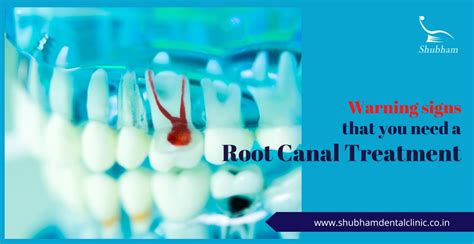 Warning Signs That You Need Root Canal Treatment Shubham Dental Clinic