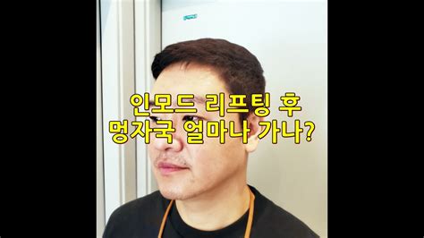 인모드 리프팅 볼처짐 인모드멍 인모드 시술 후 5일간의 변화 다시 올림 Youtube