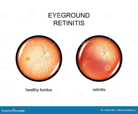 Eye Fundus Retinitis Stock Vector Illustration Of Humor 116016709