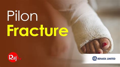 Life After Pilon Fracture At Ruby Najar Blog