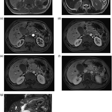 Magnetic Resonance Images Showing A Tumor In The Pancreatic Head The