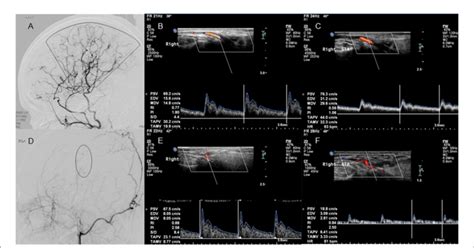Figure Lateral Projection Of Eca Angiogram And Sta Ultrasound Images In