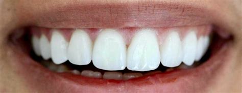 How To Choose Veneers Or Braces
