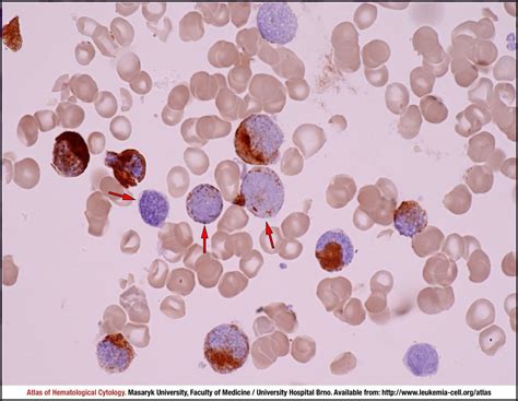 Myelodysplastic Syndrome With Excess Blasts Mds Eb 2 Cell Atlas