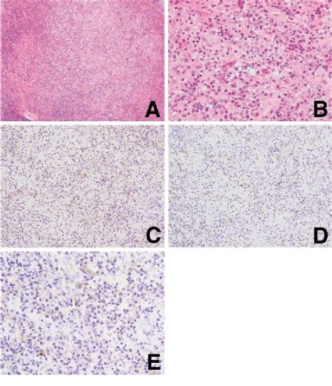 A B Photomicrographs Of The Surgical Specimen Showing Atrophic