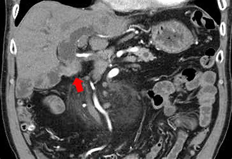 Successful Eus Guided Fine Needle Biopsy Using A Forward Viewing Echoendoscope For Local
