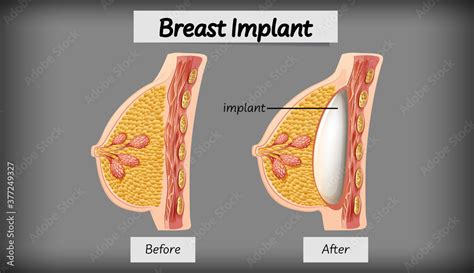 Anatomy Of Human Breast Implant Stock Vector Adobe Stock