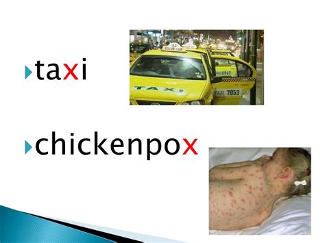 Chickenpox Cks