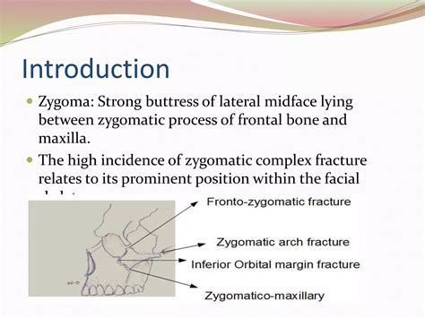 Management Of Zygomatic Complex Fractures Pptx