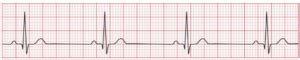 Pediatric Bradycardia With A Pulse Poor Perfusion Algorithm PALS Algorithms ACLS