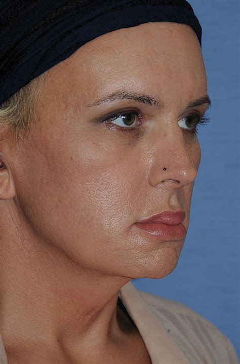 Transgender Surgery Before And After Photos Seattle Bellevue