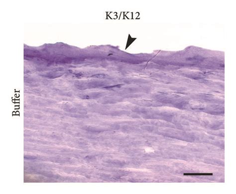 The Immunohistochemical Detection Of Cytokeratins K3k12 And The