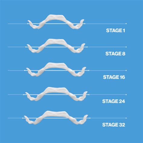 Invisalign Palatal Expander Invisalign