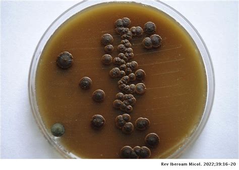 Ventriculoperitoneal Shunt Infection By Cryptococcus Neoformans Sensu Stricto Case Report And